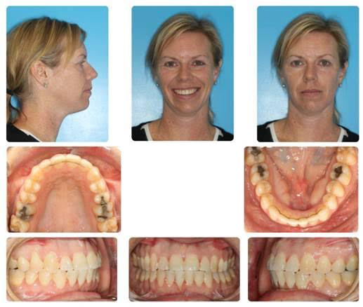 Orthognathic Surgery Melbourne | South East Orthodontics